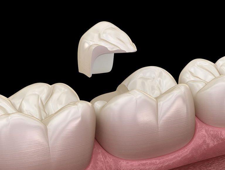 Ceramic Inlays, Onlays & Overlays Glen Allen, VA - Restorative Care